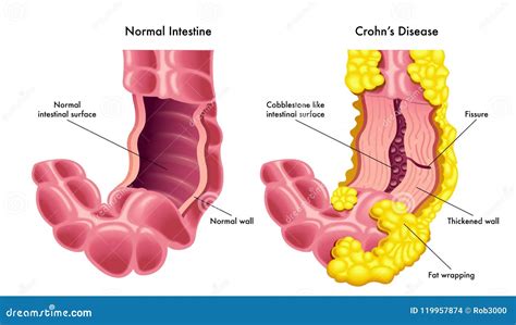 Crohns Disease Vector Illustration Labeled Diagram With Diagnosis