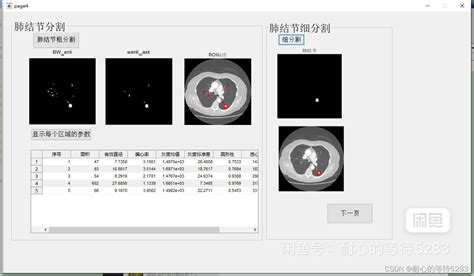 【肺结节分割】matlab肺结节分割 肺结节提取 源程序，也有gui人机界面版本 基于matlab的肺结节分割方法的研究 csdn博客