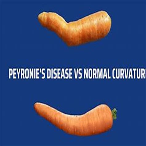 Peyronies Disease Southern Westchester Urology