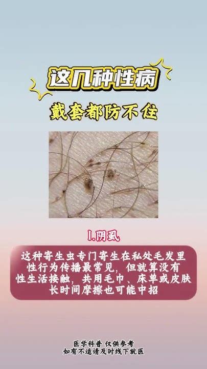 这几种性病戴套都防不住 医学科普 健康科普 女性健康 Youtube