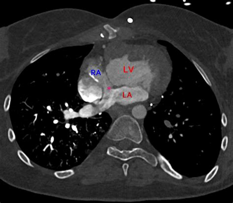 Radiopaedia Case Modified Fontan Procedure Venous Admixture Id 65834