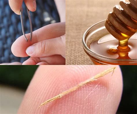How To Remove A Splinter With Honey Easily At Home The Health Exchange
