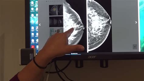 Vcu Doctor Urges Women To Follow New Mammogram Age Guidelines