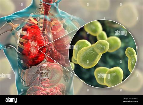 Pulmonary Cryptococcosis Invasion Of A Lung Tissue By Yeast Fungi Cryptococcus Neoformans With