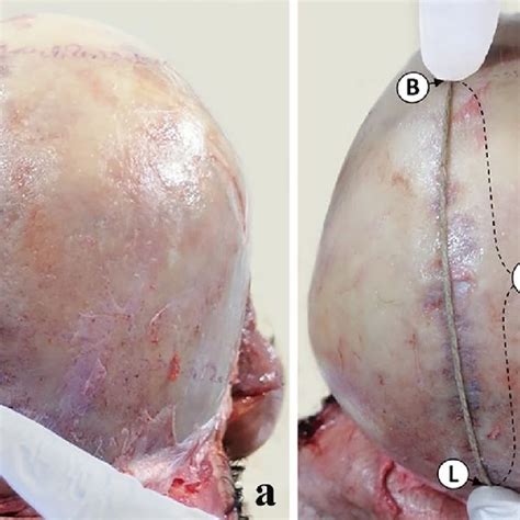 Pdf Coronal And Sagittal Suture Lengths As Novel Measurements For Sex