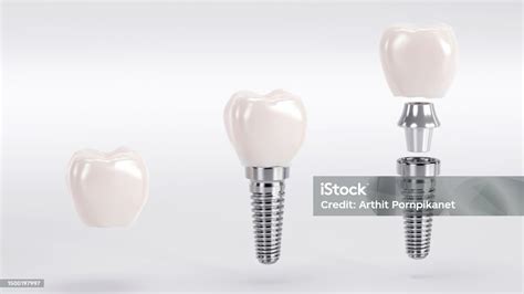 구강학 세트를 위한 치아와 치과 임플란트의 3d 렌더링 임플란트 수술 개념 임플란트에 대한 스톡 사진 및 기타 이미지 임플란트 치아 건강 디지털 생성 이미지 Istock
