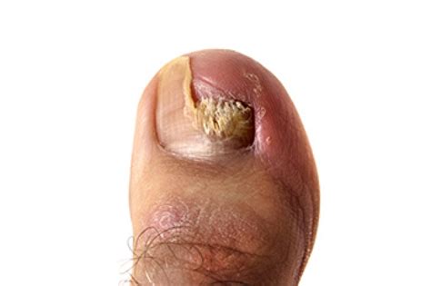 Causes And Risk Factors Of Split Toenails