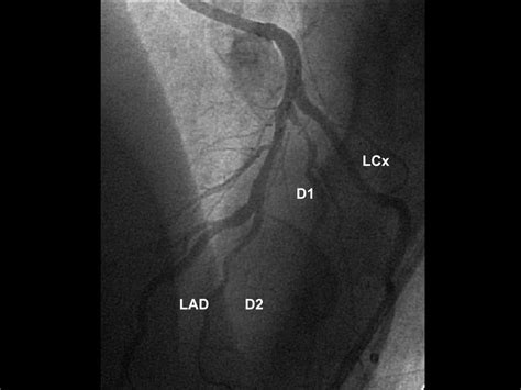 Ppt Bifurcation Lad D2 Lesion Provisional T Stenting Additional Stenting Of D1 Lesion