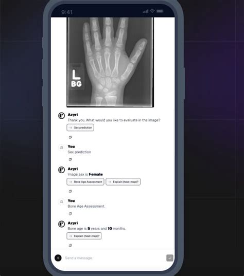 Ai Bone Age Assessment Bone Age