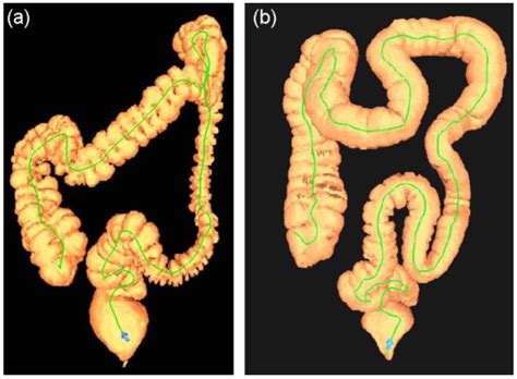 Examples Of Computed Tomography Colonography Ct Three Dimensional Download Scientific Diagram