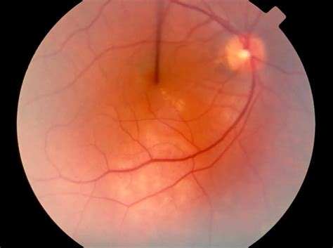 Choroidal Hemangioma American Academy Of Ophthalmology
