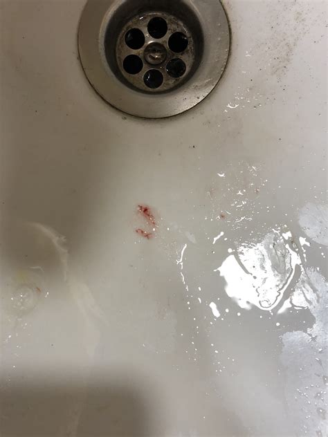 Болят лимфоузлы на шее Постоянно болят лимфоузлы на шее Ощущение сдавливание Medaboutme