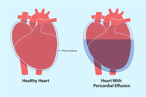 Pericardial Effusion Causes Symptoms Diagnosis And Treatment