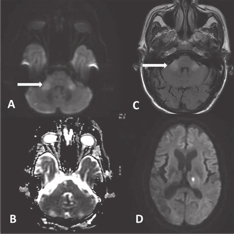 Mri Revealing Diffusion Restriction With Flair Hyperintensites In