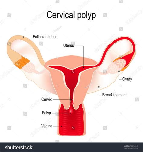Cervical Canal