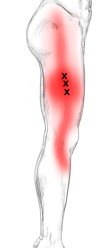 Quadratus Femoris Trigger Point Frontiers Advancing Musculoskeletal