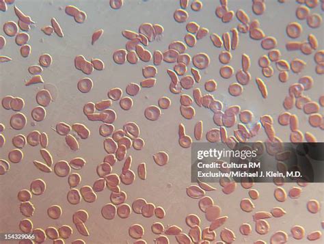 Sickle Cell Micrograph Photos And Premium High Res Pictures Getty Images