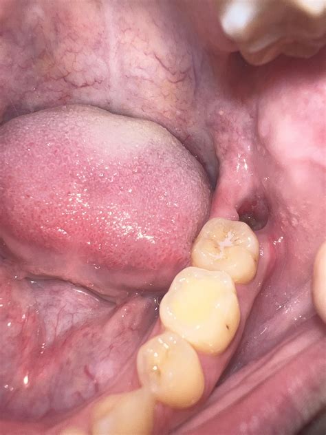 Wisdom Tooth Socket Timeline Rwisdomteeth