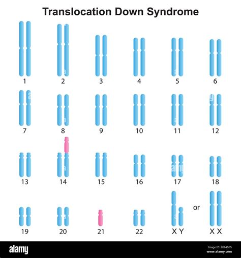 Scientific Designing Of Robertsonian Translocation Down Syndrome