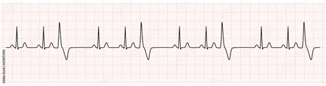 Ekg Monitor Showing Sinus Rhythm With Trigeminy Pvc Stock Vector Adobe Stock