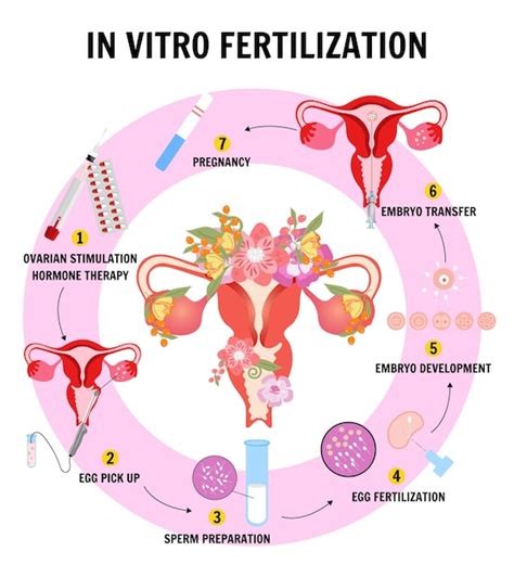 Premium Vector In Vitro Fertilization Process Infographic In Vector