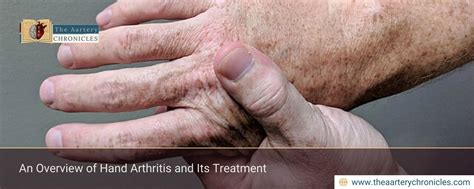 An Overview Of Hand Arthritis And Its Treatment