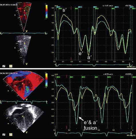Advanced Cardiac Imaging In The Newborn Tissue Doppler Imaging And Speckle Tracking