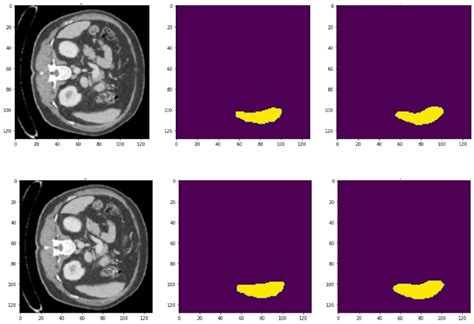 segmentation of liver tumors by monai and pytorch in ct images with