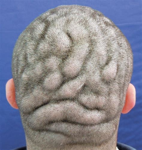 Condition Makes Mans Scalp Look Like Surface Of Brain