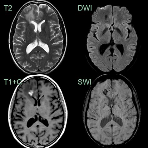 Linear Scleroderma Neuroradiology