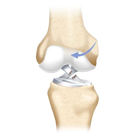 Hamstring Tendon Graft Reconstruction Of The Acl Physioflow Pt Physical Therapy Vancouver Wa