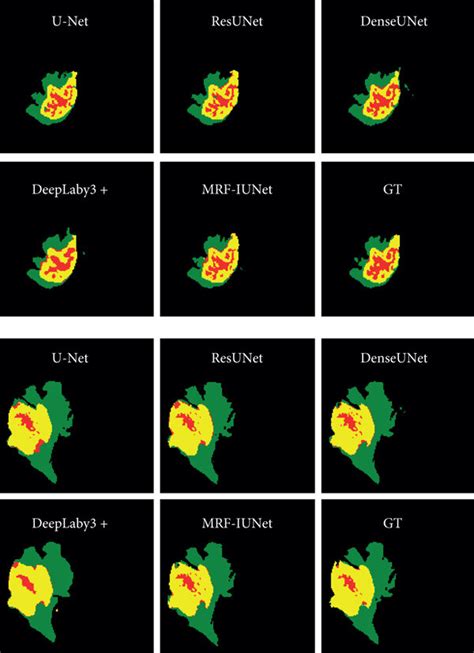 Example Segmentation Results On The Brats Dataset From Left To Right Download Scientific