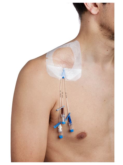 Dialysis Port In Chest