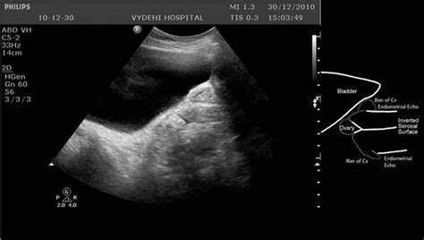 Technique Of Abdominal Hysterectomy For Non Puerperal Uterine Inversion