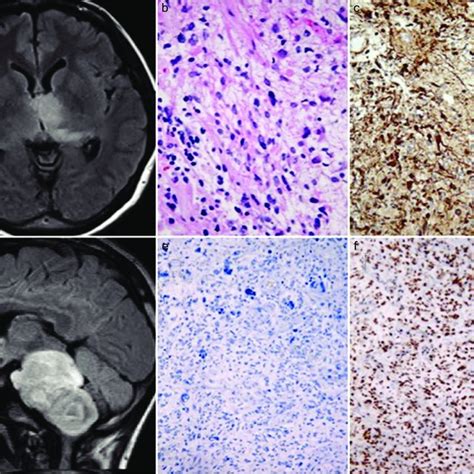 Diffuse Midline Glioma H3 K27M Mutant A Axial FLAIR MRI Shows An Download Scientific