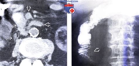 Рентгенограмма КТ МРТ УЗИ при раке двенадцатиперстной кишки