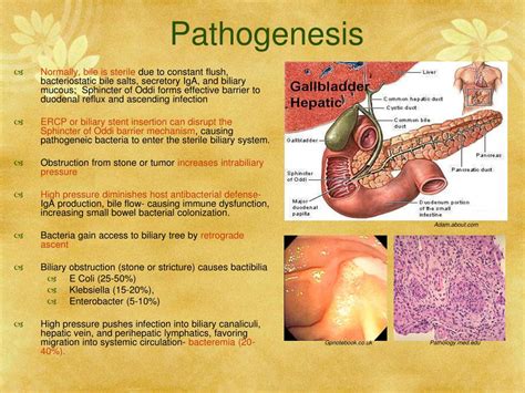 PPT Cholangitis Management Of Choledocholithiasis PowerPoint Presentation ID