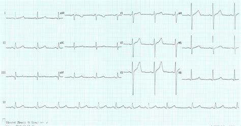 8 Basal Ecg Showing A Borderline Prolonged Qtc Interval Qtc 0 454 S Download Scientific
