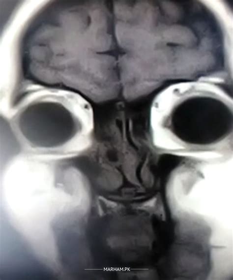 Ask A Ent Specialist Online For Ride Side Dns With Nose Blockage Plus Patu