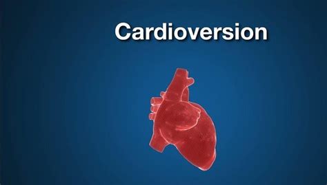 What Arrhythmias Are Treated With Cardioversion