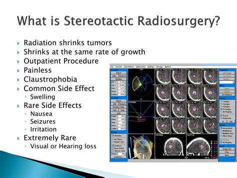 Stereotactic Radiosurgery Guidelines At Angela Bates Blog