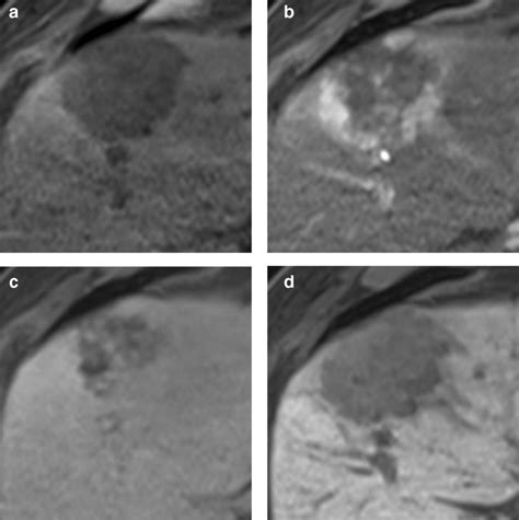 Representative Case Of Combined Hepatocellular And Cholangiocarcinoma Download Scientific Representative Case Of Combined Hepatocellular And Cholangiocarcinoma Download Scientific