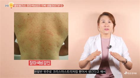 피부에 온 감기 물방울건선 Vs 장미색비강진 감별점과 치료관리법 Ft 인설 각질 이소한의원
