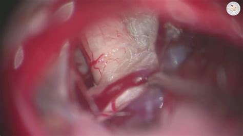 Multiple Offending Vessels Trigeminal Neuralgia Operative Video