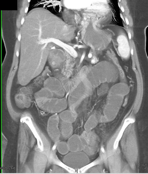 Small Bowel Obstruction Sbo Due To Small Bowel Adenocarcinoma Small