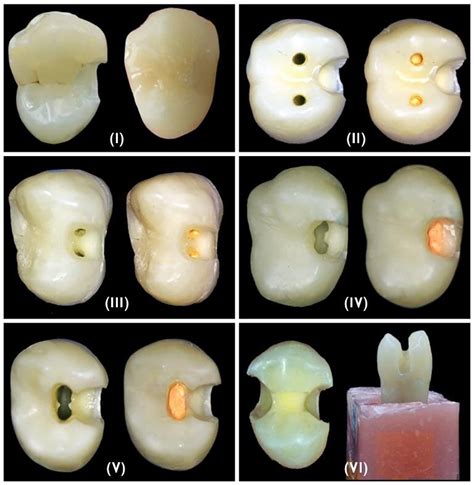 Types Of Endodontic Access Cavity Design Group I Proximal Cavity