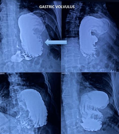 Laparoscopic Proximal Sleeve Gastrectomy As An Alternative For