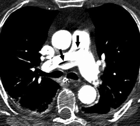 Pulmonary Embolism In Ct