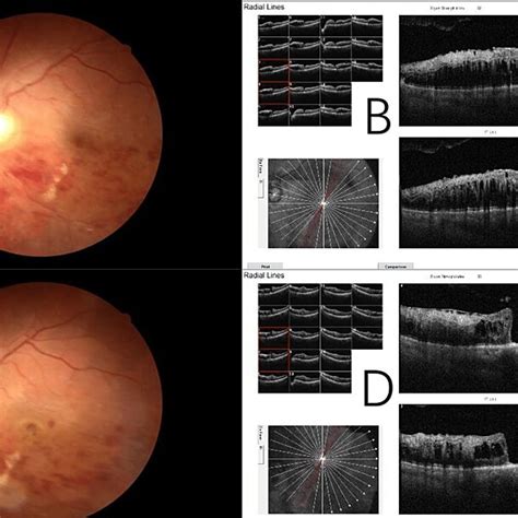 Pre Surgery Fundus Color Images And Oct Images Oct Optical Coherence Download Scientific