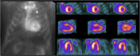 Nuclear Medicine Scan Heart